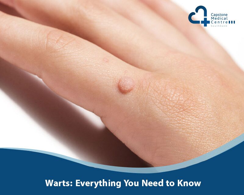 Warts: Everything You Need to Know - Capstone Medical Centre Southbank